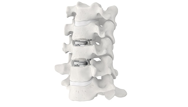 Motion Preservation Houston | Cervical Disc Replacement Houston