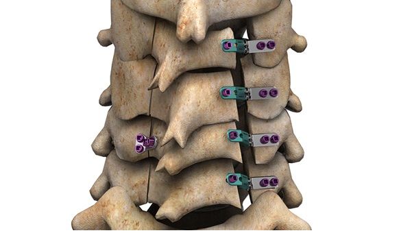 Motion Preservation Houston | Cervical Disc Replacement Houston